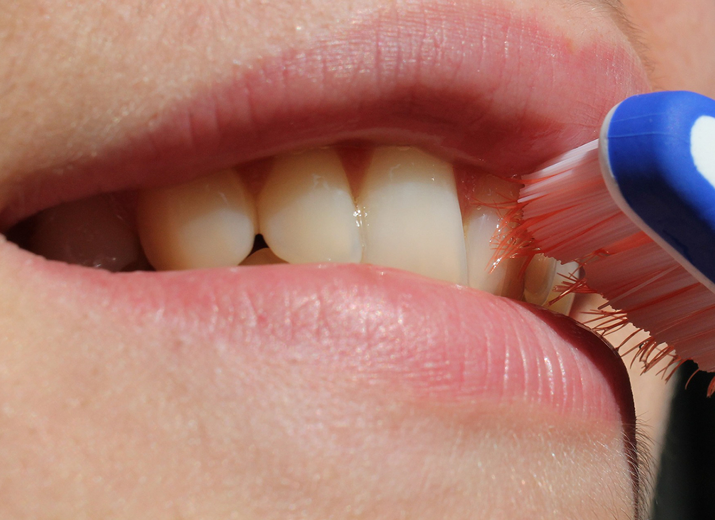 Loosened Teeth - Emergency Dentist