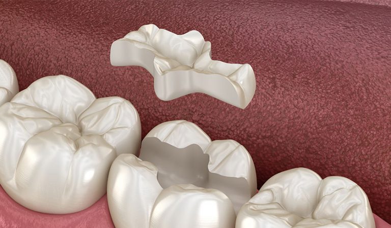 Broken Filling Treatment | Emergency Dentist London