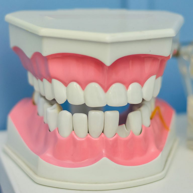 Knocked-out Tooth Treatment | Emergency Dentist London