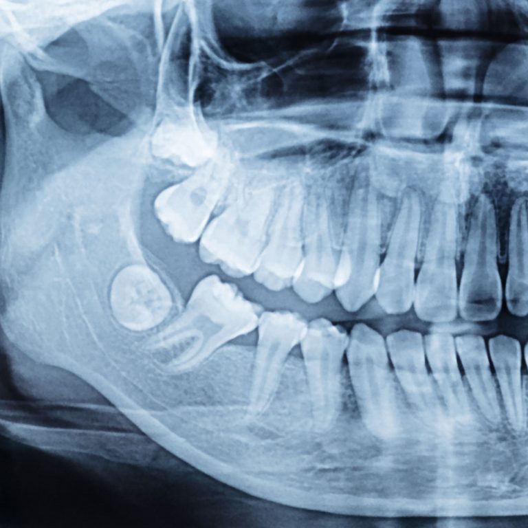 Wisdom Tooth Extraction| Emergency Dentist London