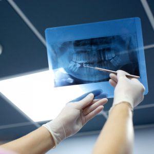ANUG (Acute Necrotising Ulcerative Gingivitis) | London