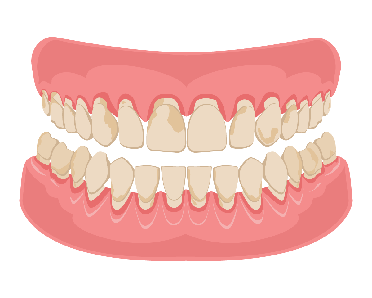 Periodontitis | London
